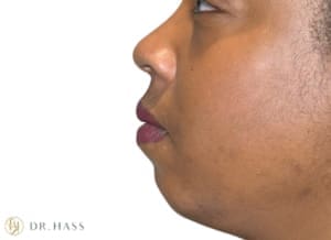 Double Chin: Causes, Prevention & Treatment | Dr Hass Clinic