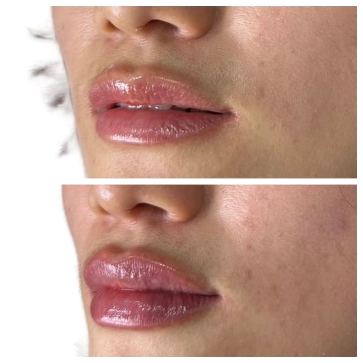 Thin Lips Guide: Causes, Prevention & Treatments | Dr Hass Clinic