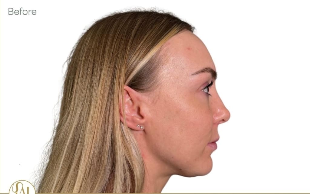How Much Cheek Filler Do You Need? 1ml vs 2ml vs 4ml | News | Dr Hass ...