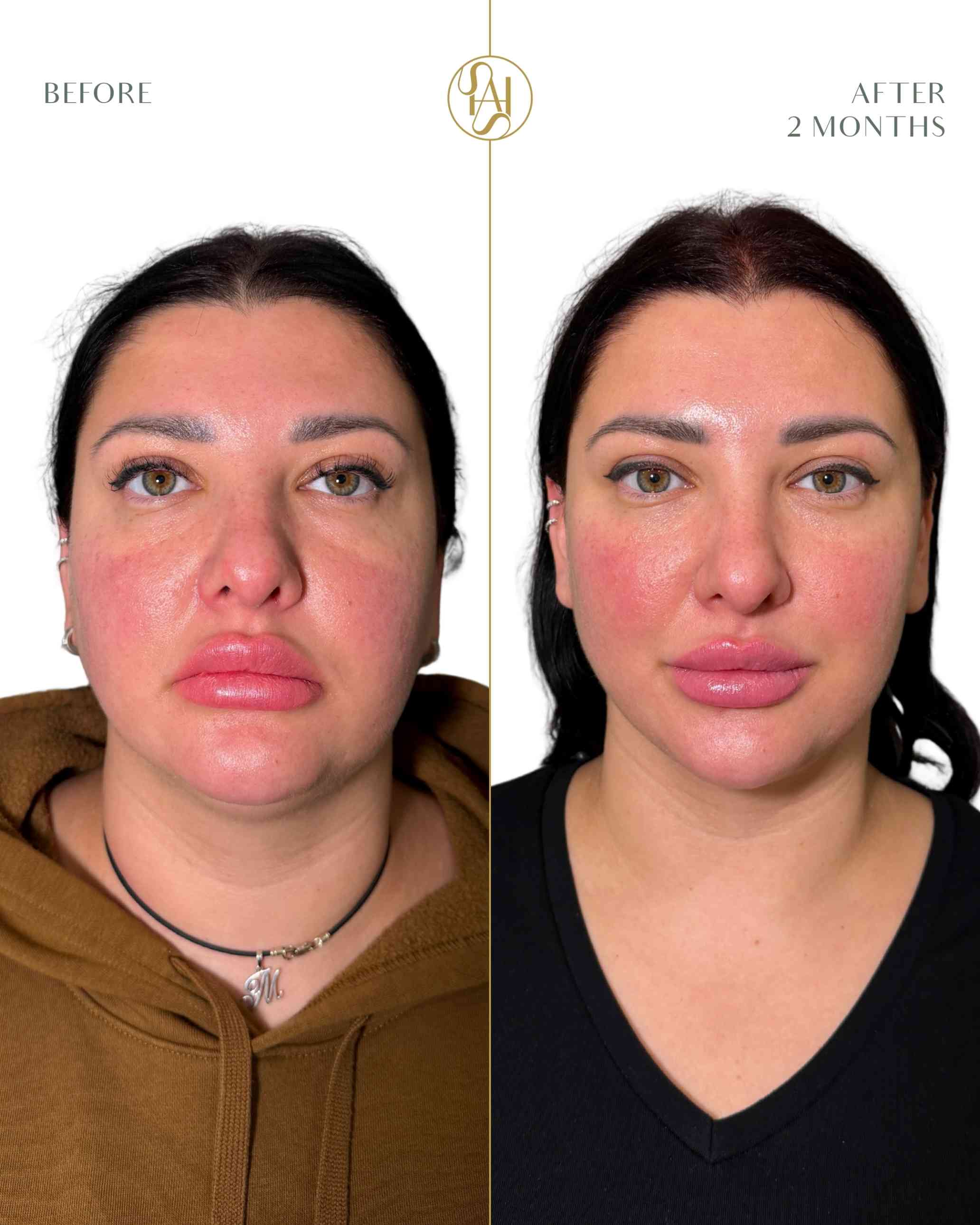 Endolift London | Non-Surgical Facelift Experts | Dr Hass Clinic