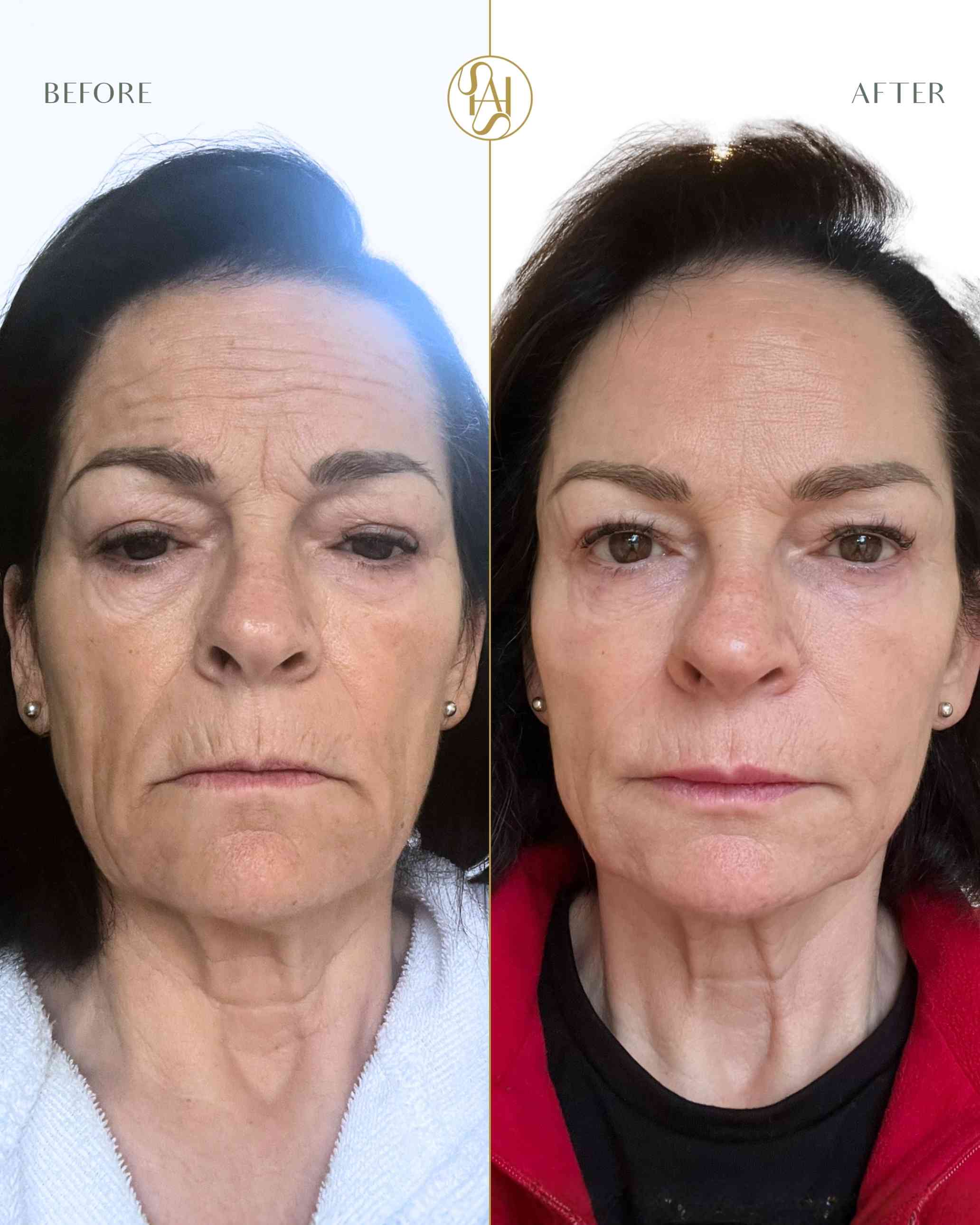 Endolift London | Non-Surgical Facelift Experts | Dr Hass Clinic