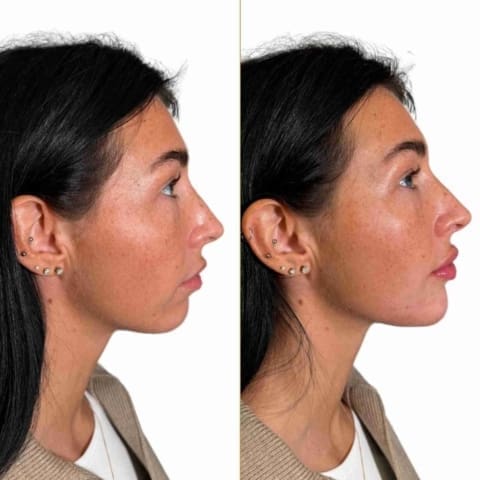 0.5ml vs 1ml Lip Filler: Key Differences Explained | Dr Hass Clinic